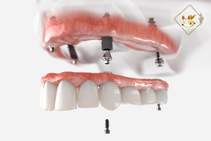 CÙNG HUỲNH KIM TÌM HIỂU VỀ IMPLANT ? – Nha khoa Huỳnh Kim Dental